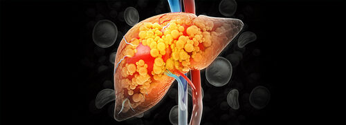 Labordiagnostik der Fettleber: Neue Nomenklatur und Screening ...